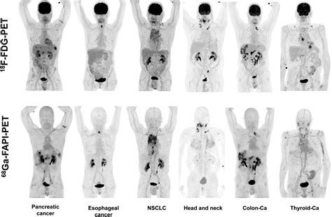 Fap The Next Billion Dollar Nuclear Theranostics Target Journal Of Nuclear Medicine