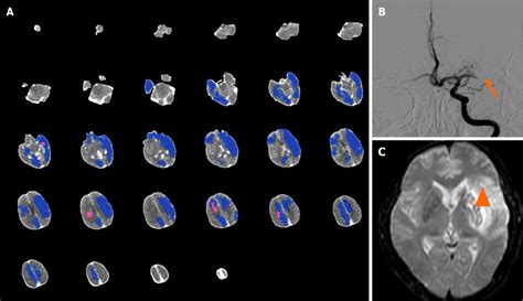 Artificial Intelligence Software For Assessing Brain Ischemic Penumbracore Infarction On