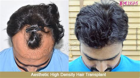 How Prp And Combined Method Of Hair Transplant Gives The Best Results