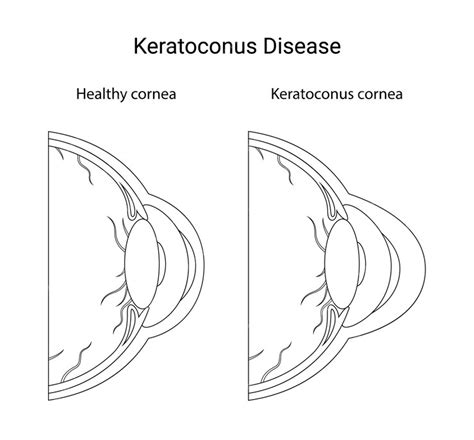 Premium Vector Healthy Cornea And Keratoconus Cornea In Line Illustration
