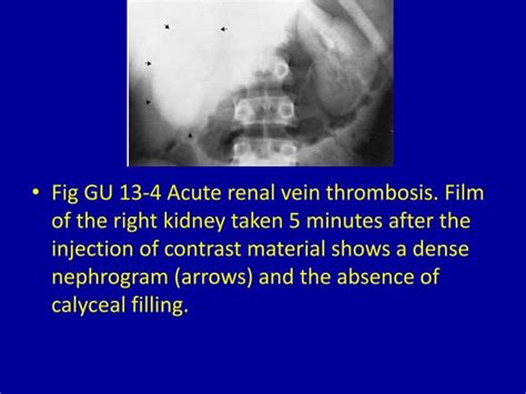 13 Persistent Or Increasingly Dense Nephrogram Pptx