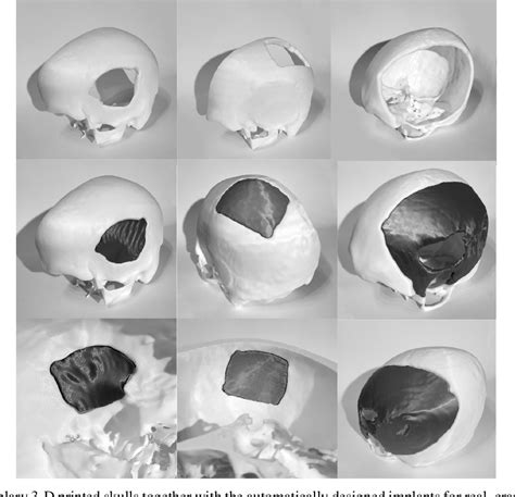 Figure From Deep Learning Based Framework For Automatic Cranial Defect Reconstruction And