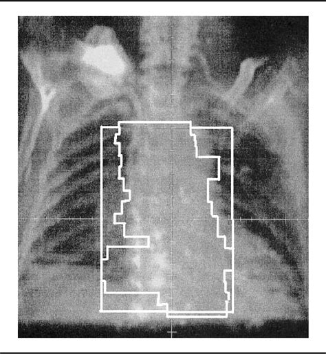 Figure 1 From Life Threatening Pacemaker Dysfunction Associated With