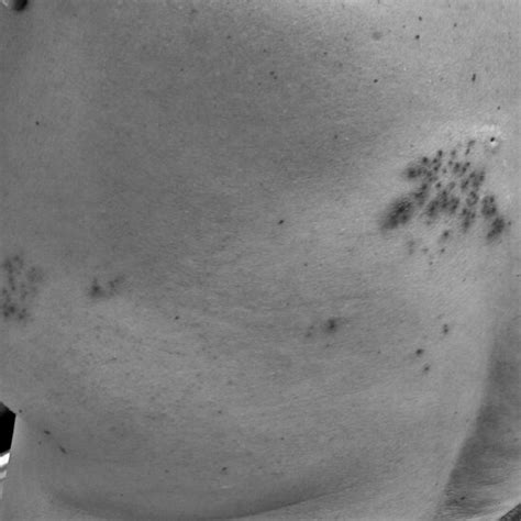 Paravertebral Dorsal Root Ganglia Sympathetic Ganglia With Serous
