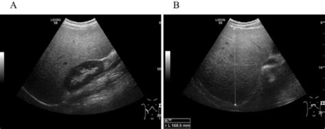 General 2 W5 L2 Diffuse Liver Disease Flashcards Quizlet