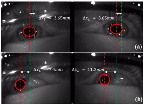 23 A Leftright Eye Position And Difference Between The Two Eyes Download Scientific Diagram