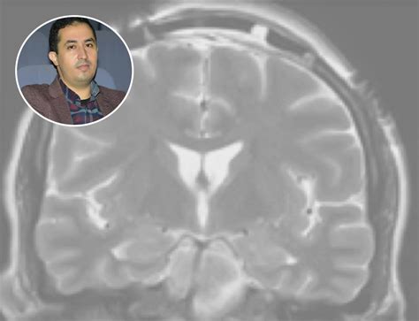 Calvarial Metastasis With Dural Sinus Invasion A Case Report