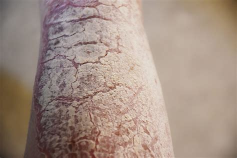 Patients With Erythrodermic Psoriasis Find Relief With Golimumab