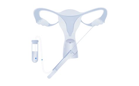 Ivf Egg Retrieval Process Procedure Recovery Risks And More