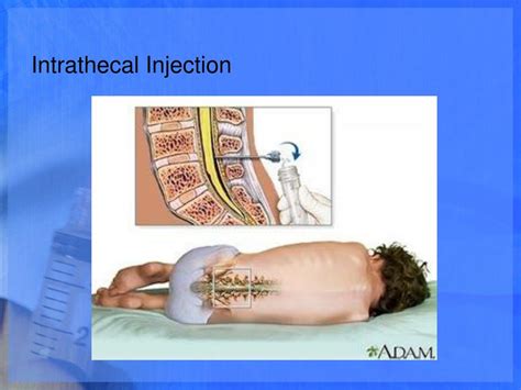 Function Of Intrathecal Injection At Robert Parsley Blog
