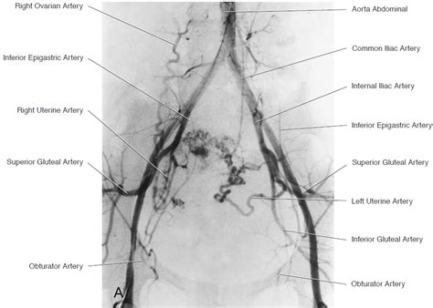 Obturator Artery Angiogram
