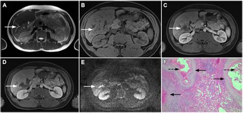 Current Oncology Free Full Text Imaging Spectrum Of Intrahepatic