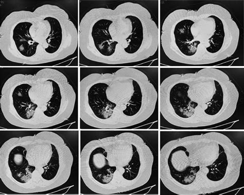 Chest Ct Image Of The Patient At Admission Chest Ct Showed Patchy