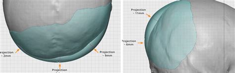 Right Occipital Plagiocephaly Custom Skull Implant Dimensions Dr Barry