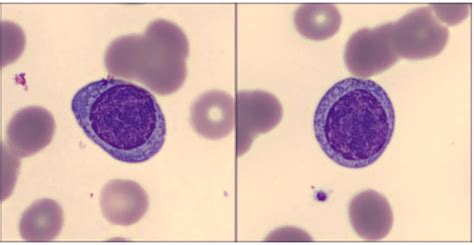 「m」影追踪——1例多发性骨髓瘤的诊断之路 医学界 助力医生临床决策和职业成长