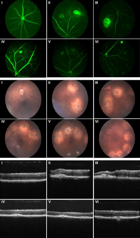 Non Invasive Evaluation Of Laser Induced Choroidal Neovascularization Download Scientific