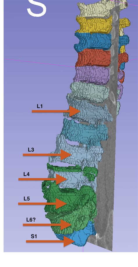 What Happens Encountering `transitional Vertebrae` When Segmenting The Spine In
