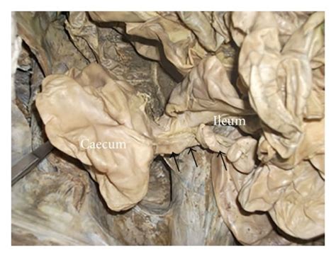 Position Of The Appendix Arrow A Retrocecal Appendix Note The