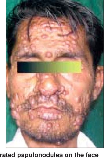 Figure 1 From Diffuse Cutaneous Leishmaniasis Co Infection With Human Immunodeficiency Virus