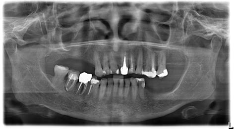 Periodontal Bone Loss Object Detection Dataset By Pbl