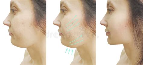 Cirugía Estética De La Barbilla Doble De La Mujer Antes Y Después De La