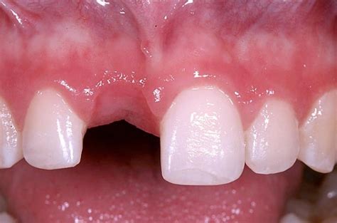 Anterior Tooth
