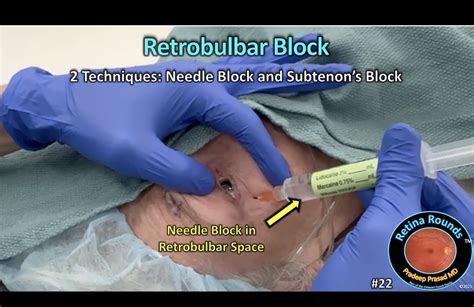Retrobulbar Block