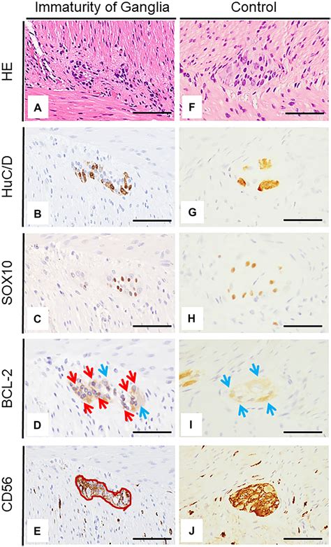 Examples Of Pathological Findings Of The Myenteric Nerve Plexus In