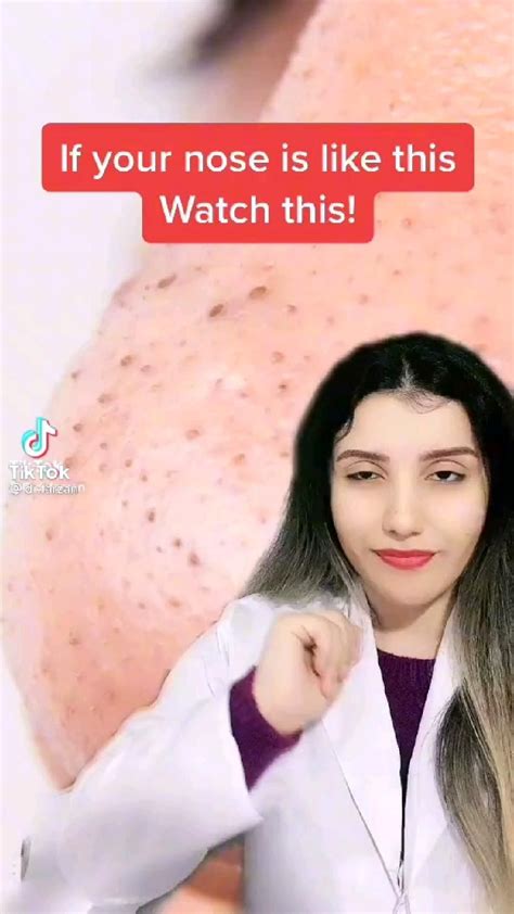 How To Get Rid Of Blackheads On Your Nose Artofit