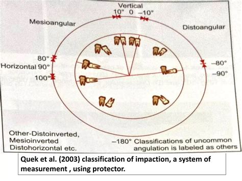 Third Molar Impaction Basic Pptx