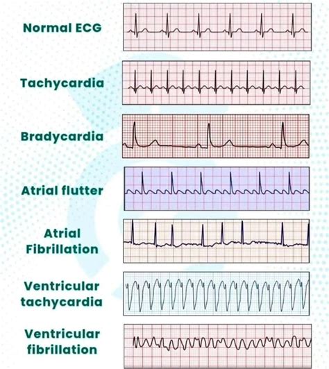 This Image Displays Various Types Of Electrocardiogram Ecg Readings