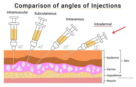 Intradermal Injection How And When To Administer