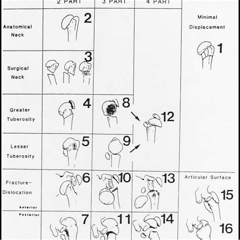 The 16 Categories Of The Neer Classification A Fracture Is Considered Download Scientific