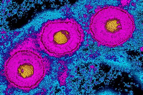 Genital Herpes Linked To Accelerated Brain Shrinkage Trendradars