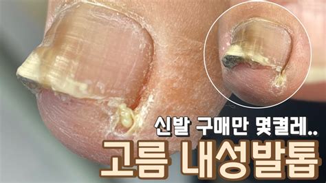 고름이 줄줄 원인 발톱은 어디에 발톱무좀ㅣ내성발톱 Youtube