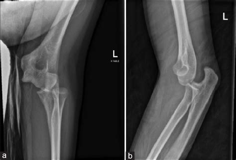 Elbow Dislocation In Sports A Narrative Review Journal Of Musculoskeletal Surgery And Research