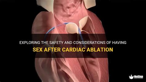 Exploring The Safety And Considerations Of Having Sex After Cardiac Ablation Medshun
