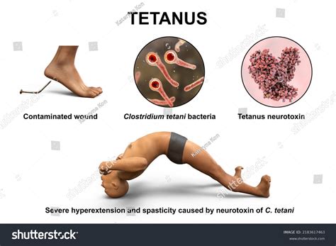 Tetanus Bacteria Diagram