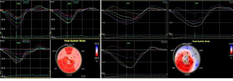 Automated Function Imaging Of Left Ventricle Before A And After B