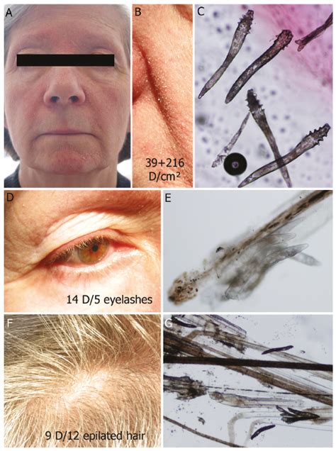 Demodex Mites Symptoms