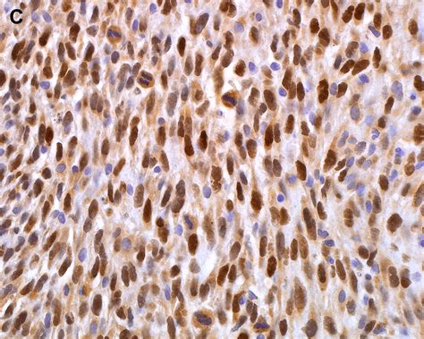 Spindle Cell Sarcomas Surgical Pathology Clinics