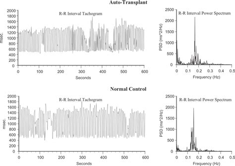 Download Heart Rate Variability Comparison Auto Transplantvs Normal Control
