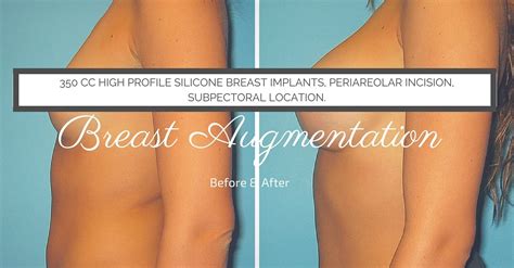 Transaxillary Breast Augmentation Ivrcqb