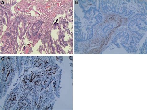 A The Tumors Were Glandular In Arrangement Under Microscope And Some Download Scientific