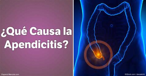¿qué Es La Apendicitis Datos Básicos Sobre Este Padecimiento