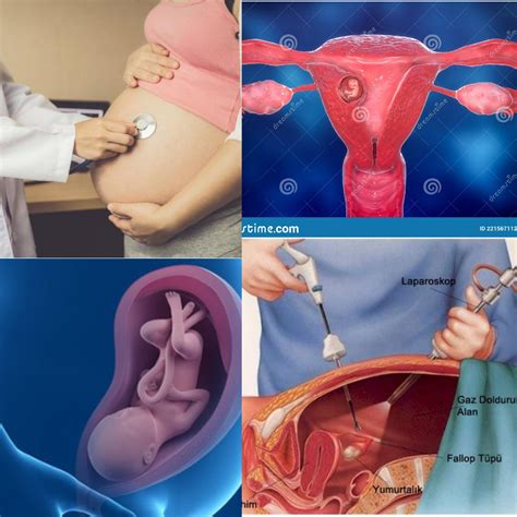 თანდაყოლილი კუნთის ტორტიკოლიზი თანდაყოლილი კუნთის ტორტიკოლიზი ირაკლიტუღუში ტორტიკოლიზი