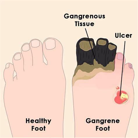 Ayurvedic Treatment Gangrene Natural Healing With Ayurveda
