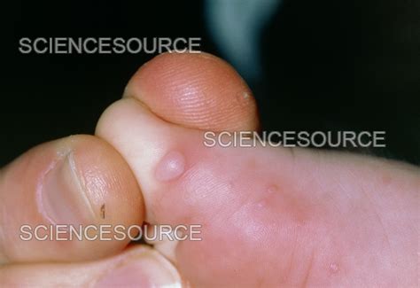 Hand Foot And Mouth Disease Lesion On Stock Image Science Source Images