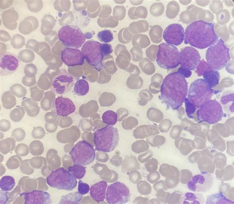 Nup214abl1 A Ph Like Fusion Found In A Pediatric Acute Myeloid