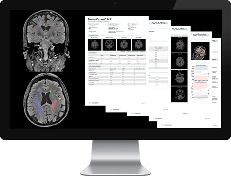 Comprehensive Volumetric Mri For The Clinical Assessment Of Multiple Sclerosis Cortechsai